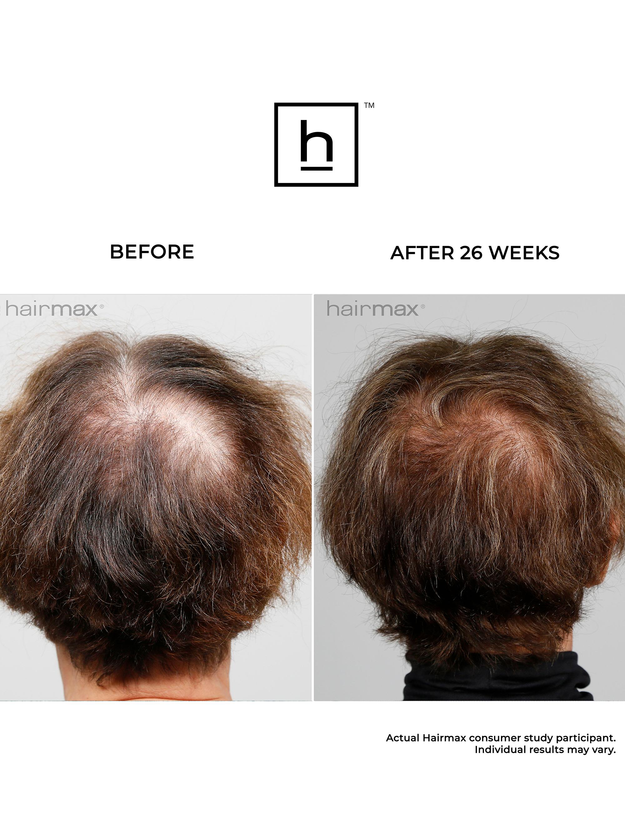 Hairmax Ultima 12 Hair Growth Lasercomb | Saks Fifth Avenue