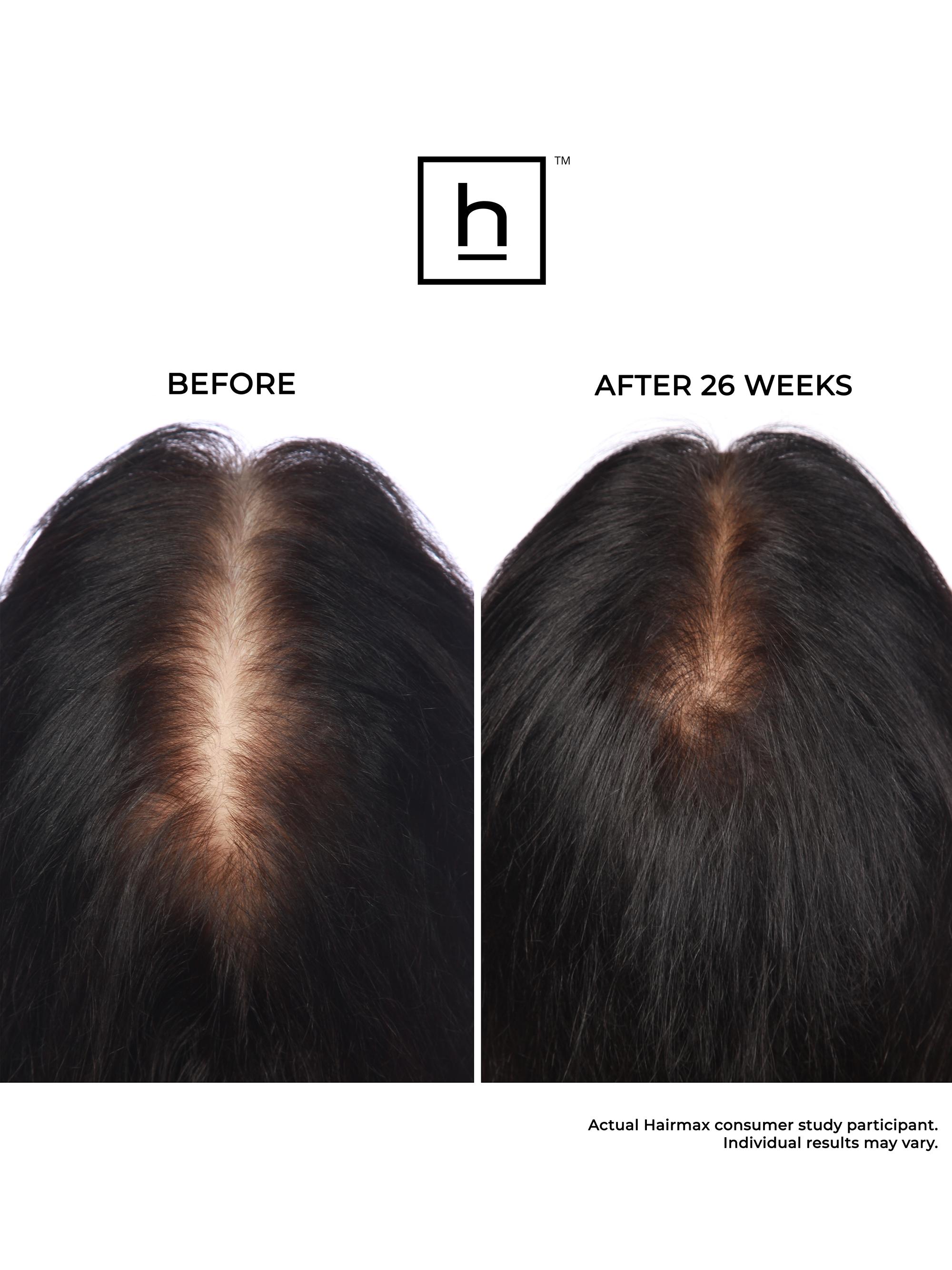 Hairmax Ultima 12 Hair Growth Lasercomb | Saks Fifth Avenue